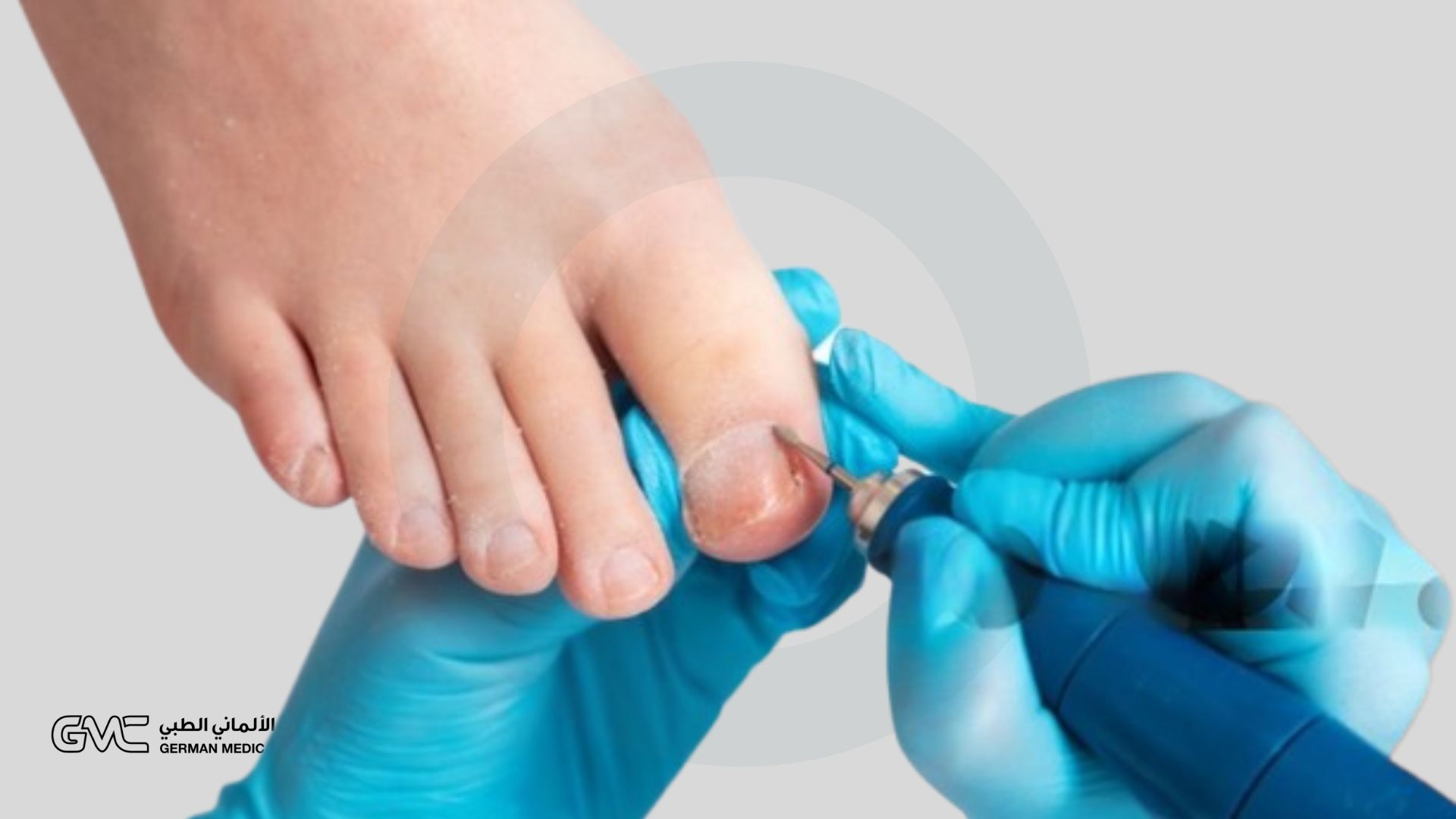Best Dermatologist in Bahrain | Effective Ingrown Toenail Treatment